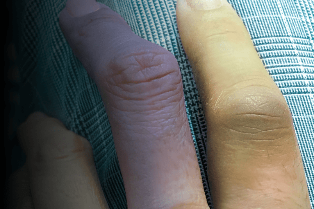 Esclerosis sistémica: 10 consejos para controlar los síntomas - Un ...