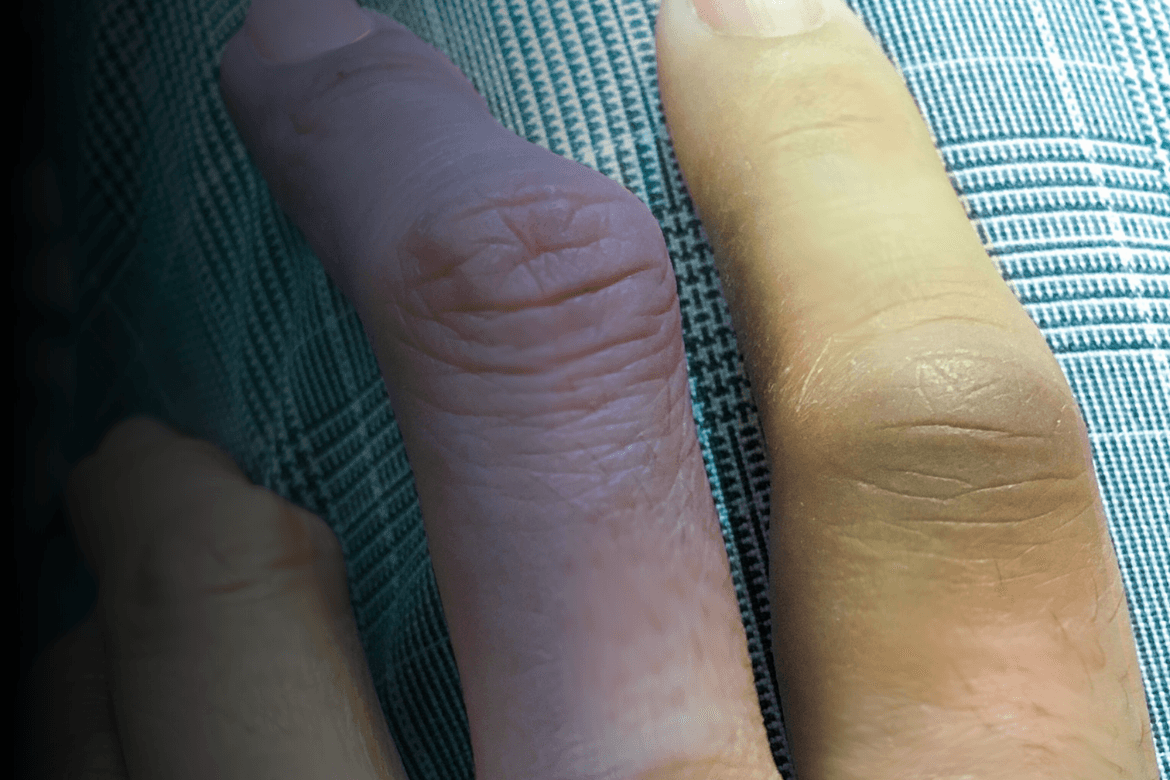 Esclerose sistêmica: 10 dicas para controlar os sintomas - Un Ensayo ...
